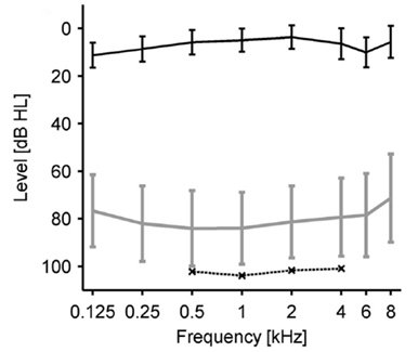 Hyperacusis Psynso